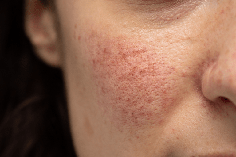 Seborrheic Dermatitis vs Rosacea: Key Differences Between The Two!