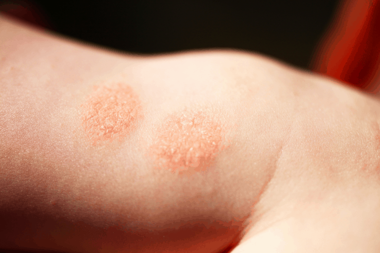 9 Early Signs Of Baby Eczema You Shouldn t Avoid 